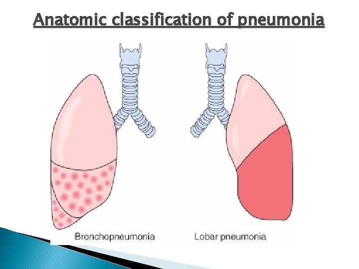 RESPIRATORY BLOCK PNEUMONIA Dr Maha Arafah Prof Ammar
