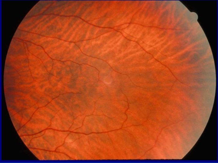 Differential Diagnosis I HIV Retinopathy or CMV retinitis