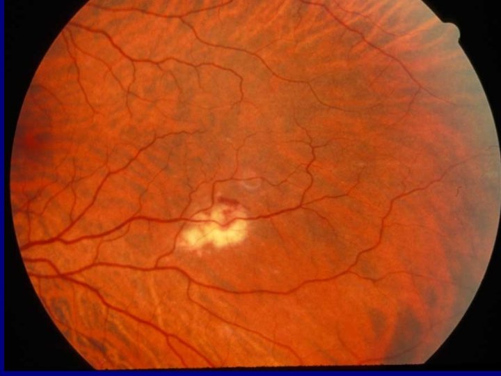 Differential Diagnosis I HIV Retinopathy or CMV retinitis