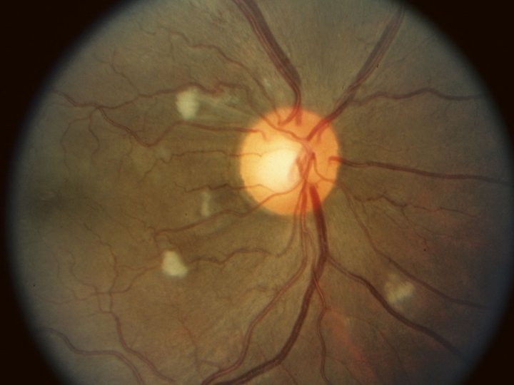 Differential Diagnosis I HIV Retinopathy or CMV retinitis