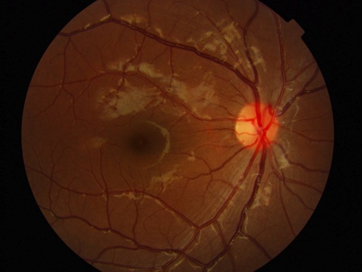 Differential Diagnosis I HIV Retinopathy or CMV retinitis