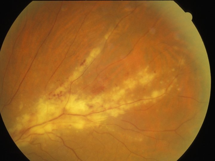 Differential Diagnosis I HIV Retinopathy or CMV retinitis
