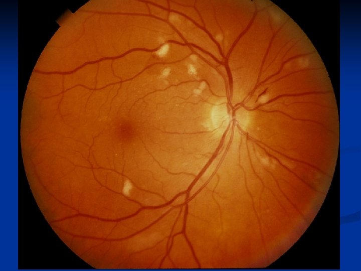Differential Diagnosis I HIV Retinopathy or CMV retinitis