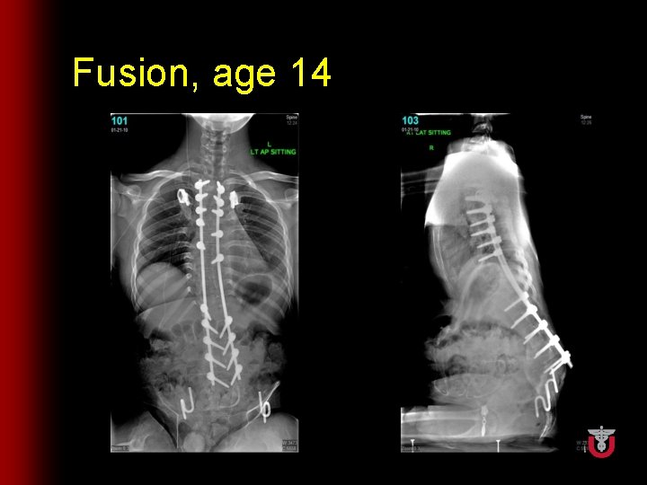 The Use of Spinal and Rib Based Distraction