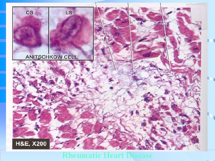 Pathology of rheumatic fever IE Valvular diseases DR