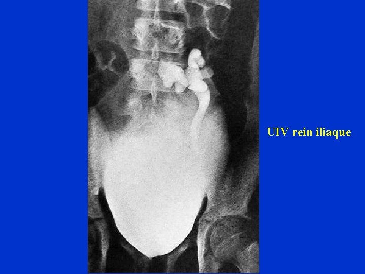MALFORMATIONS UROGENITALES II MALFORMATIONS URINAIRES A RAPPEL ...