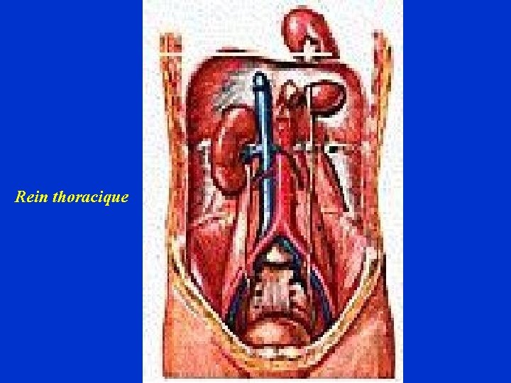 MALFORMATIONS UROGENITALES II MALFORMATIONS URINAIRES A RAPPEL ...