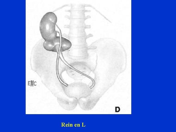 MALFORMATIONS UROGENITALES II MALFORMATIONS URINAIRES A RAPPEL ...