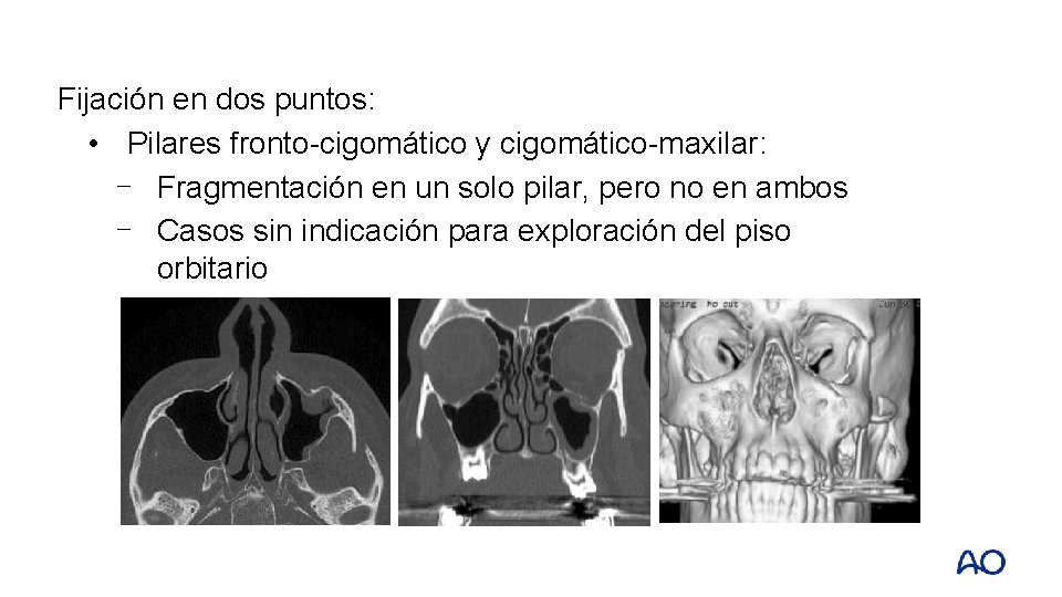 Fracturas cigomticas Objetivos de aprendizaje Describir los mecanismos