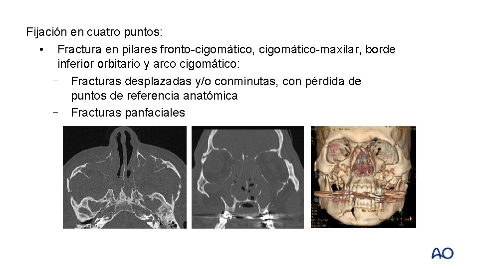 Fracturas cigomticas Objetivos de aprendizaje Describir los mecanismos