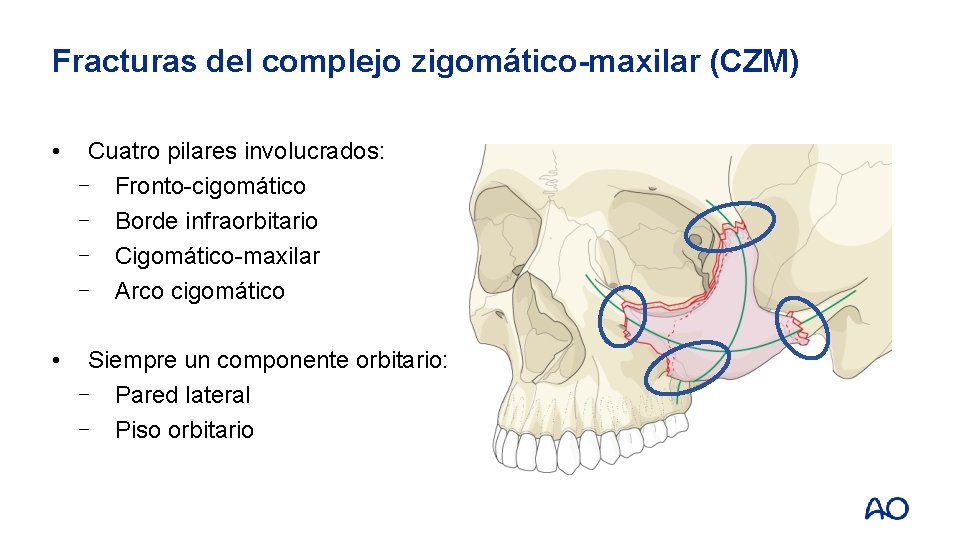 Fracturas cigomticas Objetivos de aprendizaje Describir los mecanismos
