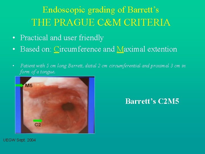 Esofago di Barrett ed adenocacinoma esofageo Esofago di