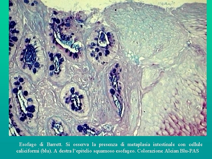 Esofago di Barrett ed adenocacinoma esofageo Esofago di