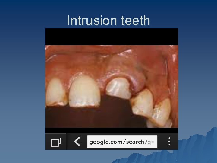 FAKTOR 2 PENYEBAB KERUSAKAN JARINGAN KERAS GIGI JARINGAN