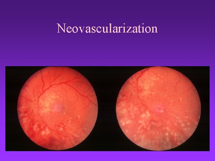 Eales disease Update DR AJAY DUDANI MUMBAI RETINA