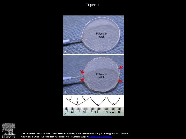 Beatingheart patch closure of muscular ventricular septal defects