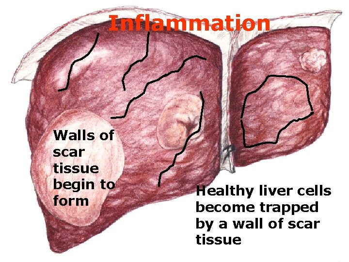 Hepatitis What Is Hepatitis Hepatitis means inflammation of
