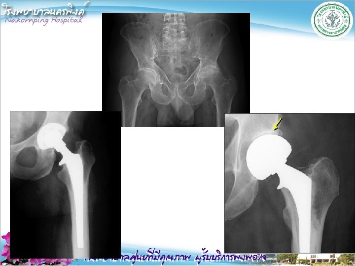 Osteoarthritis knee OA knee Osteoarthritis hip OA hip