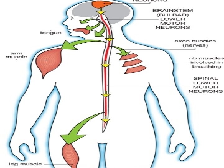 Motor Neurone Disease Gill Craig Carolyn Webber Motor