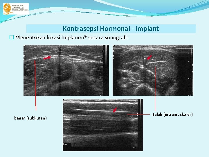 5 Kontrasepsi Hormonal b Injeksi Depo Kontrasepsi Hormonal