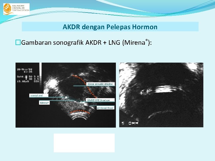 5 Kontrasepsi Hormonal b Injeksi Depo Kontrasepsi Hormonal