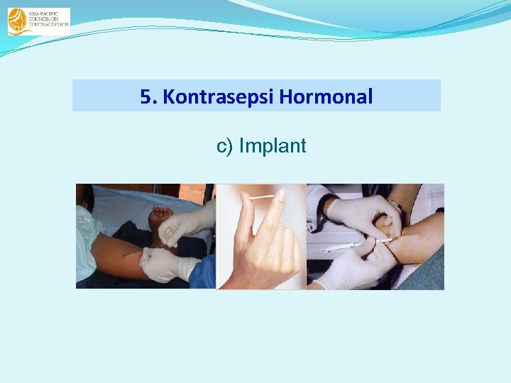 5 Kontrasepsi Hormonal b Injeksi Depo Kontrasepsi Hormonal