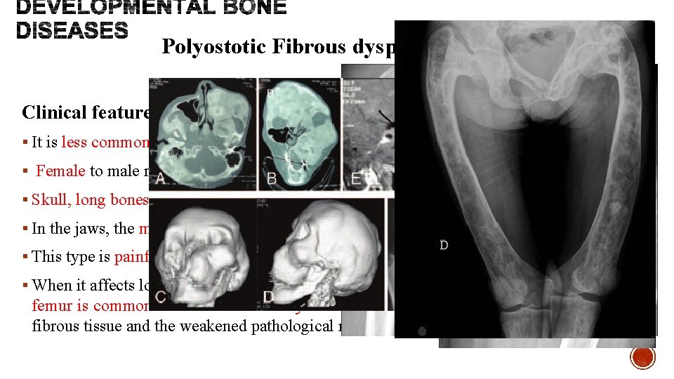 Fibrous dysplasia of bone It is a developmental