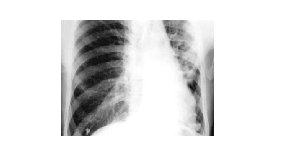 Le syndrome bronchique DEFINITION Il runit lensemble des