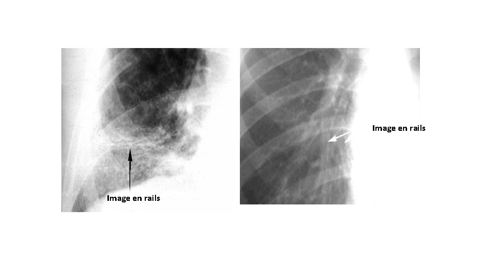 Le syndrome bronchique DEFINITION Il runit lensemble des