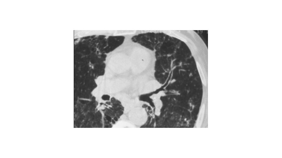 Le syndrome bronchique DEFINITION Il runit lensemble des