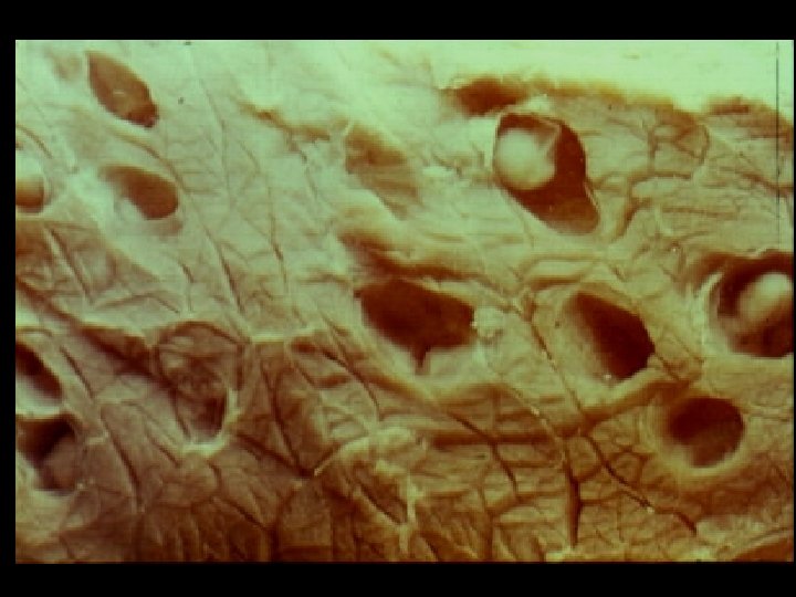 CESTODOSES LARVAIRES Cysticercose humaine Hydatidose Echinococcose ...