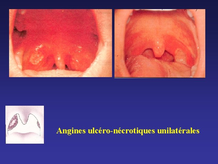 Les Angines tiologies Diagnostic volution Traitement IFSI 2007