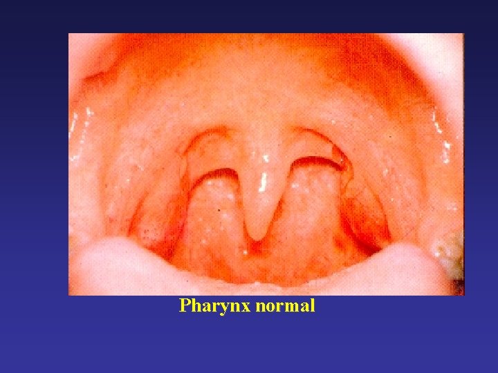 Les Angines tiologies Diagnostic volution Traitement IFSI 2007