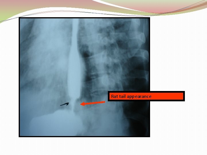 CA Esophagus Dr Mohd Azam Haseen Associate Professor