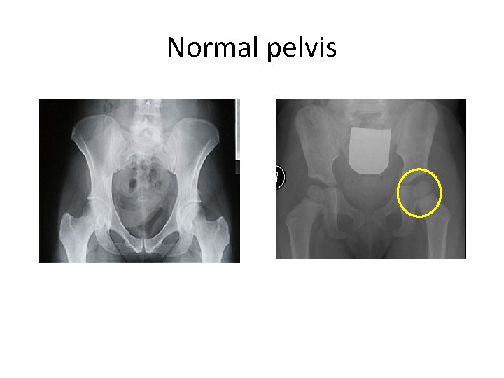 Common Pediatric Hip Problem Prof Mohamed Zamzam Common