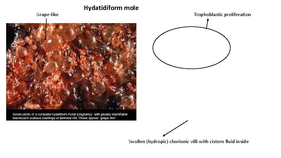 Normal chorionic villi products of conception Trophoblastic epithelium