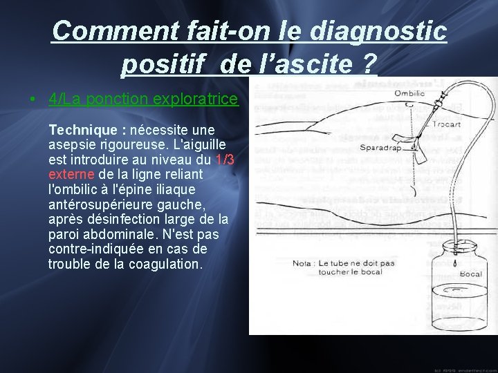 LAscite ORIENTATION DIAGNOSTIQUE DEVANT UNE ASCITE ralise par