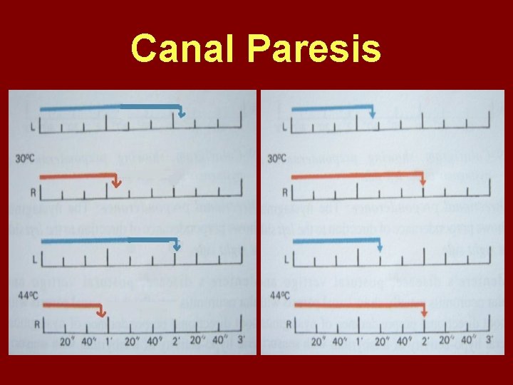 Clinical Tests for Vestibular Function Dr Vishal Sharma