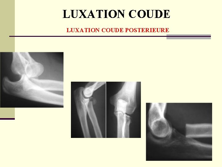 LUXATION COUDE A MENADI FACULTE DE MEDECINE ANNABA