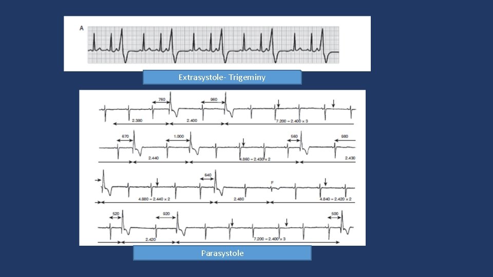 Ventricular Tachycardia in Structural Heart Disease Dr Sanmath
