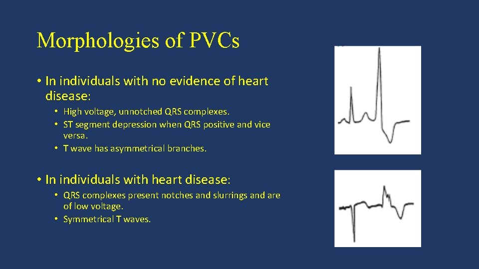 Ventricular Tachycardia in Structural Heart Disease Dr Sanmath