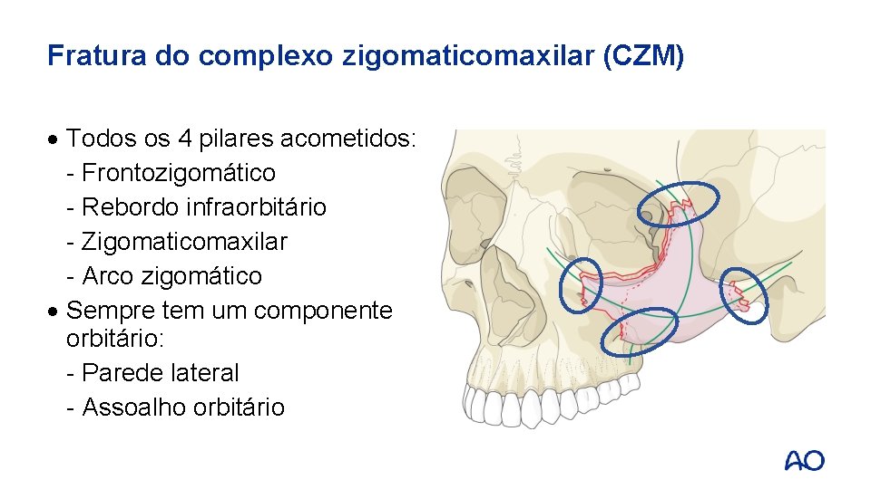 Fraturas zigomticas Objetivos de aprendizagem Descrever os mecanismos