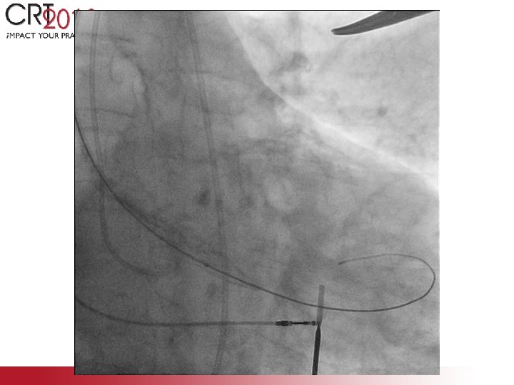 The SelfExpanding Medtronic Core Valve Transcatheter Valve System