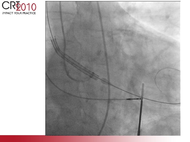 The SelfExpanding Medtronic Core Valve Transcatheter Valve System