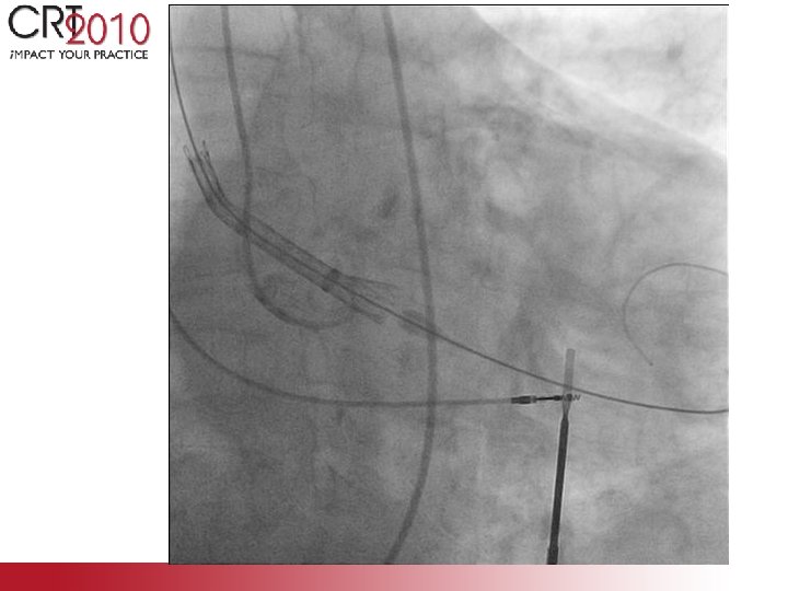 The SelfExpanding Medtronic Core Valve Transcatheter Valve System