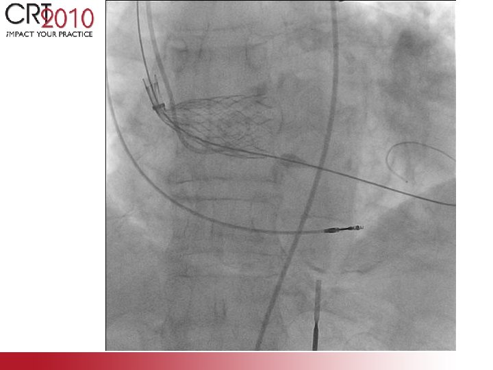 The SelfExpanding Medtronic Core Valve Transcatheter Valve System