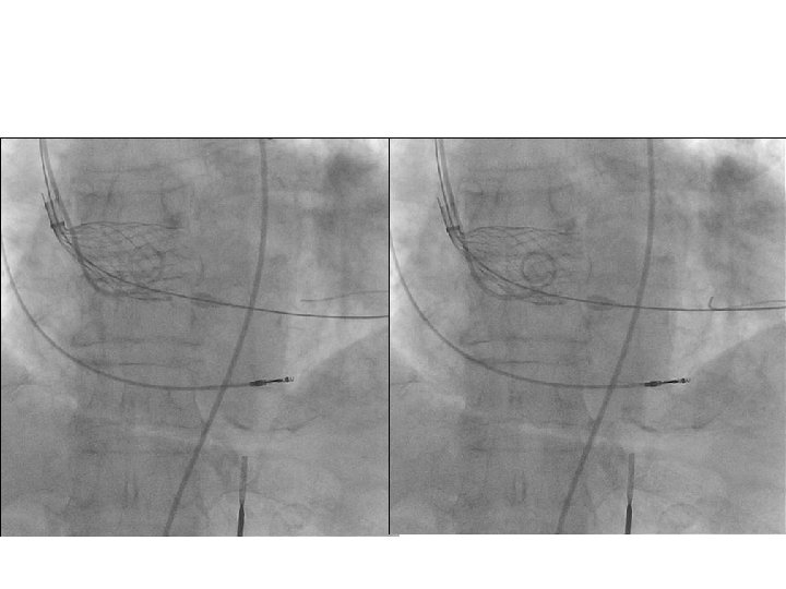 The SelfExpanding Medtronic Core Valve Transcatheter Valve System