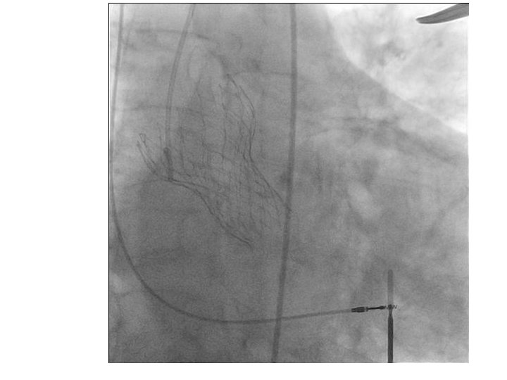 The SelfExpanding Medtronic Core Valve Transcatheter Valve System