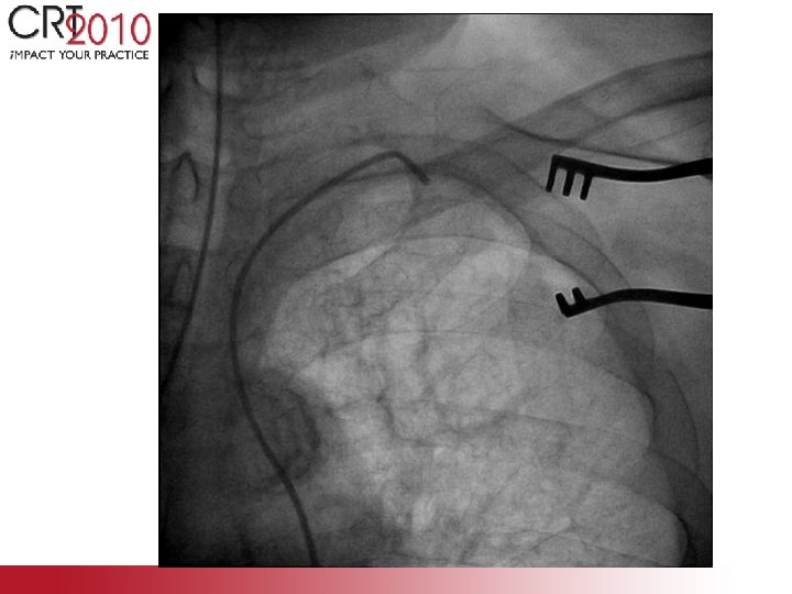 The SelfExpanding Medtronic Core Valve Transcatheter Valve System