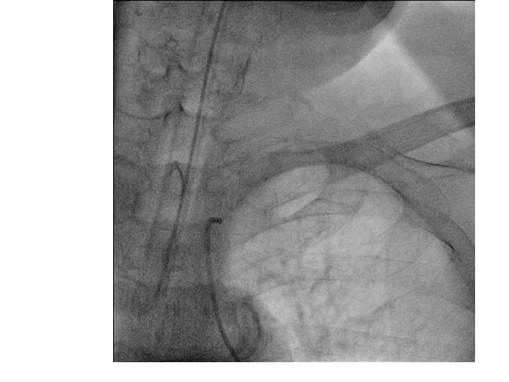 The SelfExpanding Medtronic Core Valve Transcatheter Valve System